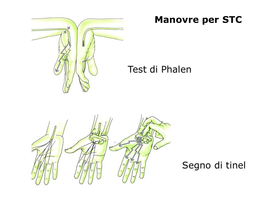 Sindrome Del Tunnel Carpale Fisiomusica